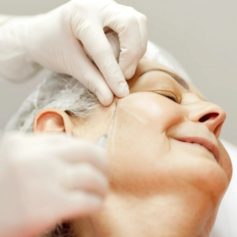Bioestimulador de colágeno | Onodera Estética
